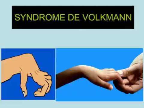 Syndrome de VOLKMANN - Traumatologie - YouTube