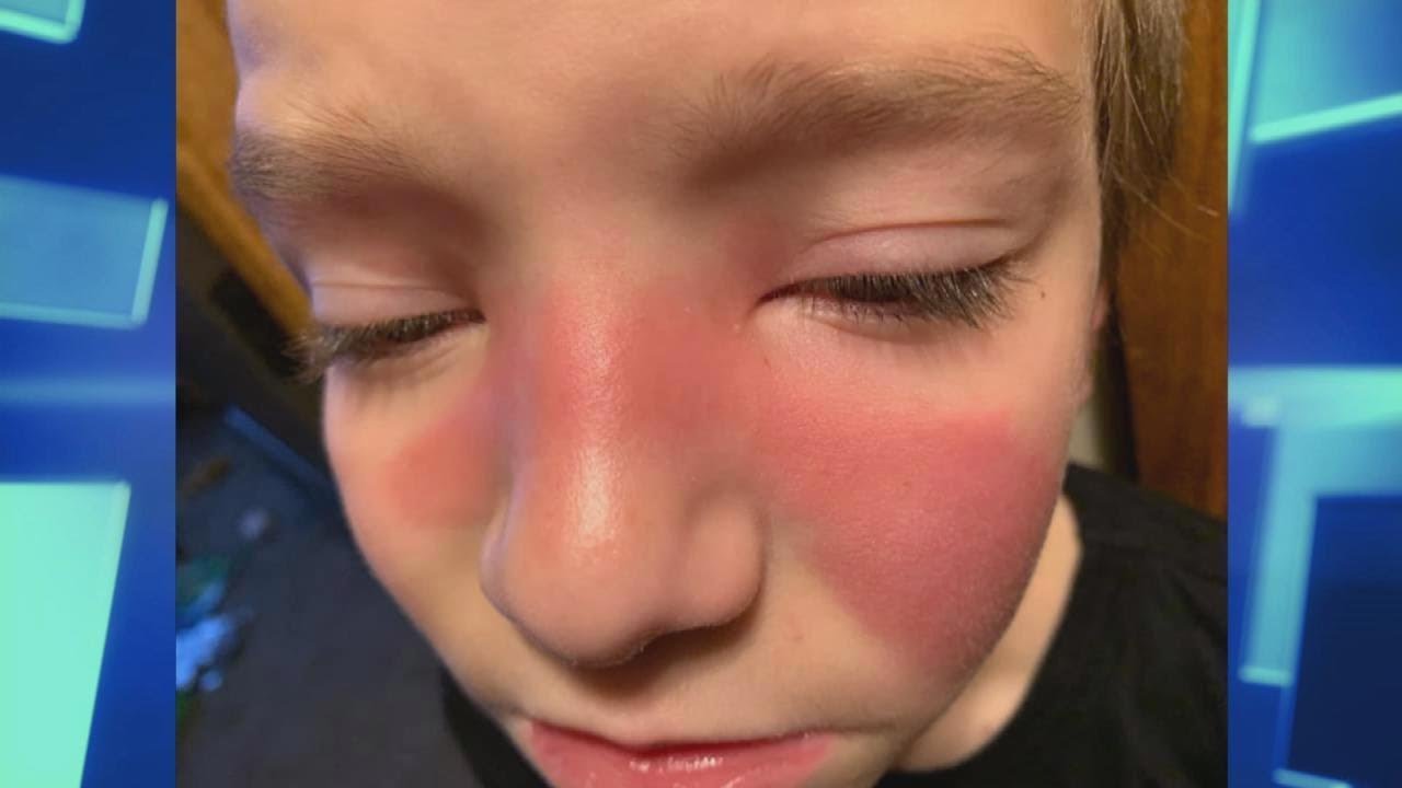 Erysipelas: What Is It and How to Treat It - YouTube