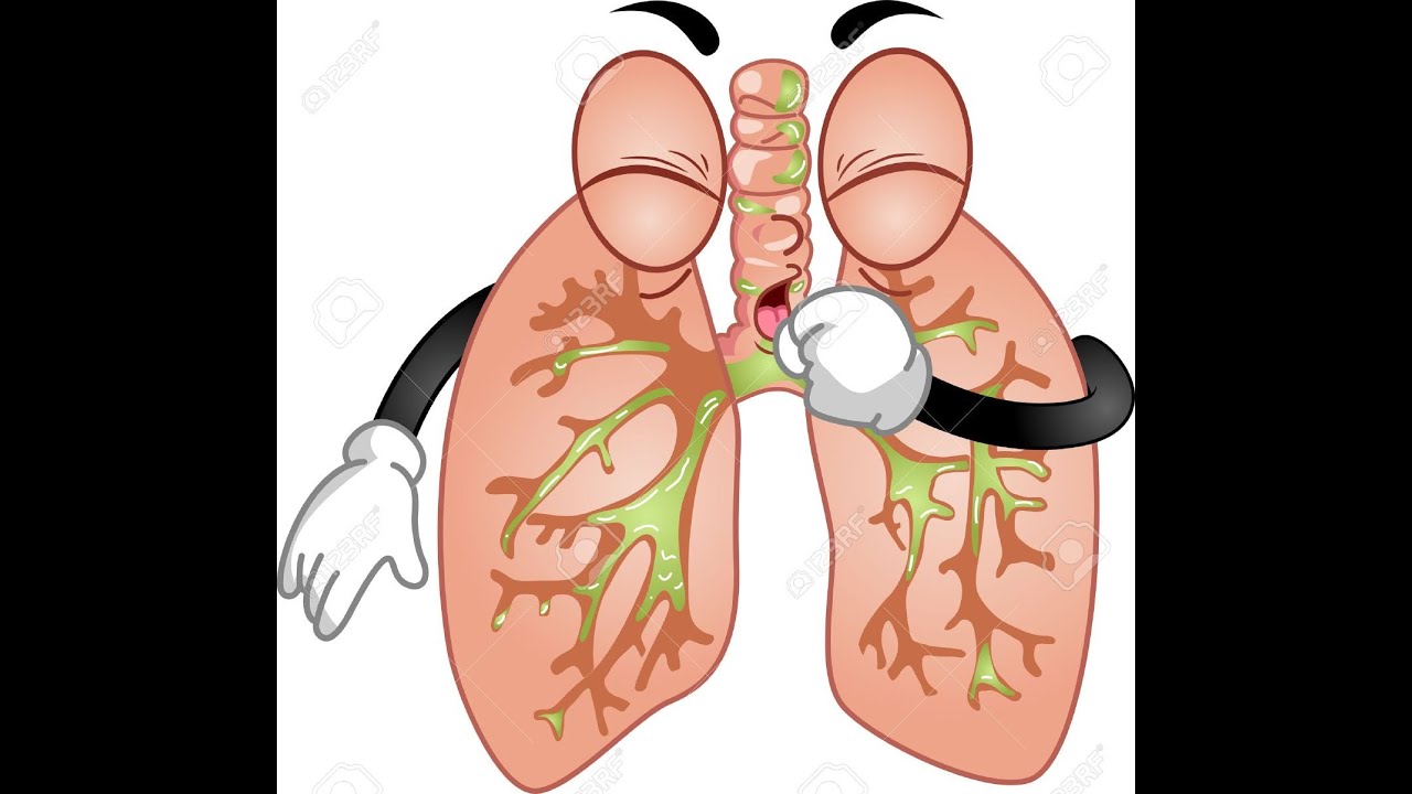 PRIMARY TUBERCULOSIS-Ghon's complex (or) primary complex-Related to ...