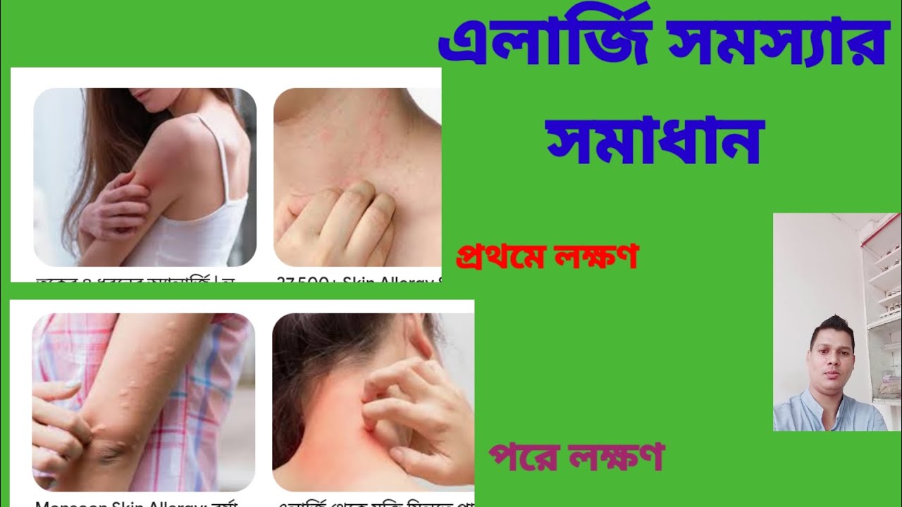 Allergy problem solution. এলার্জি সমস্যার সমাধান - YouTube