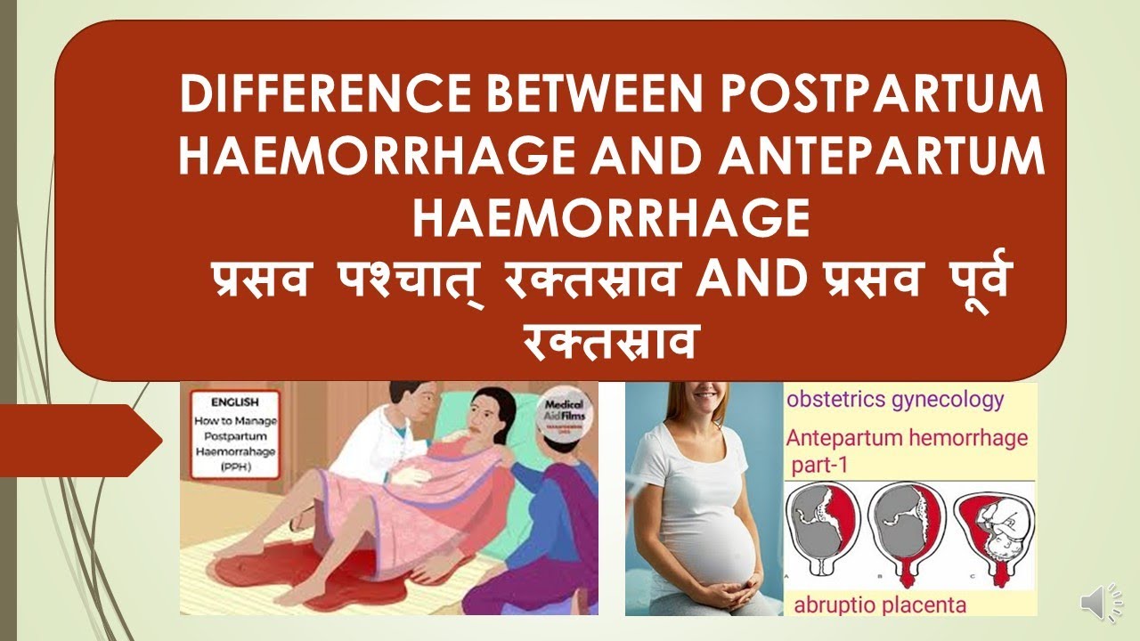 DIFFERENCE BETWEEN POSTPARTUM HAEMORRHAGE AND ANTEPARTUM HAEMORRHAGE ...
