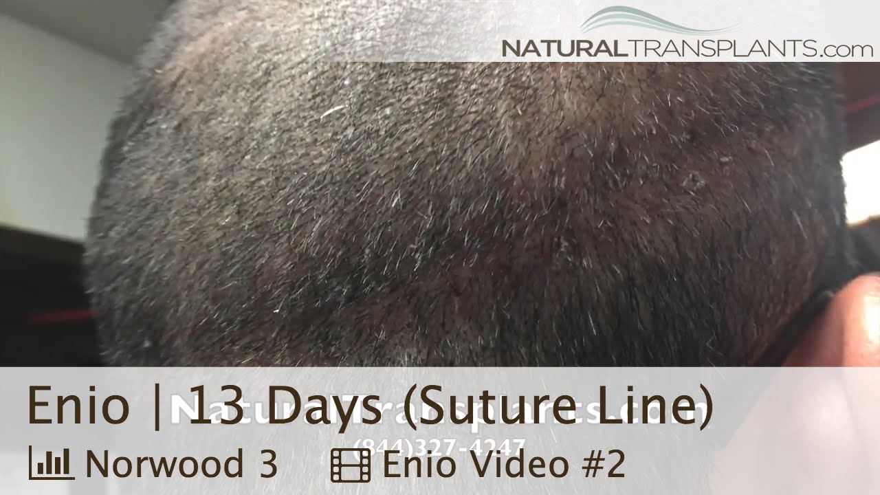 Hair Transplant Suture Line | Hair Doctor Miami (Enio) - YouTube