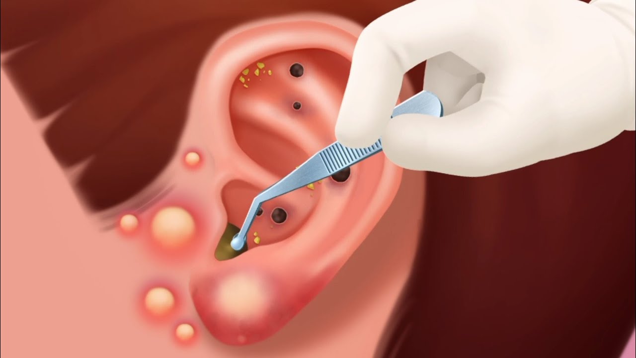 ASMR Ear Treatment | Damage Ear To Beautiful Ear | ASMR #asmr - YouTube