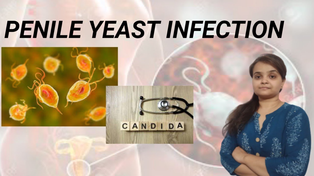 PENILE YEAST INFECTION (SYMPTOMS, DIAGNOSIS, PREVENTION,TREATMENT ...