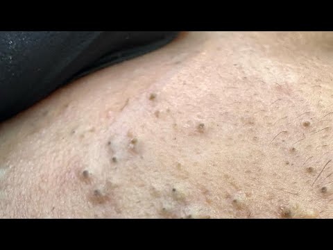 The Most Satisfying Pimple Extraction We've Ever Recorded - YouTube