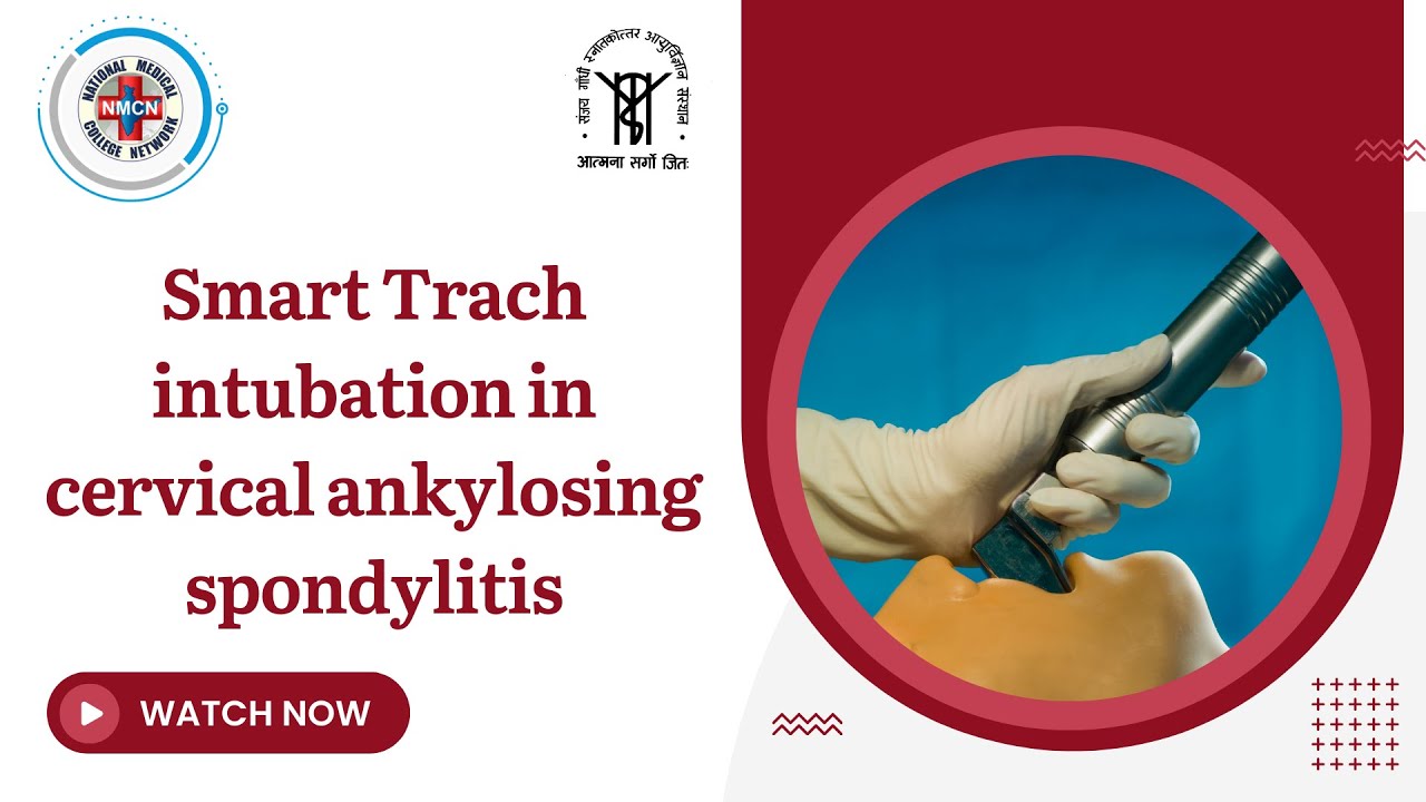 Smart Trach intubation in cervical ankylosing spondylitis, Dr Ashish K ...