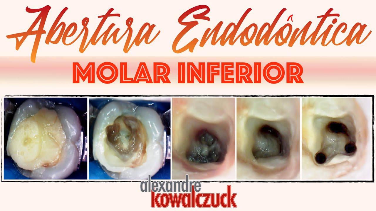 Acesso Endodontico Molar Inferior - RETOEDU