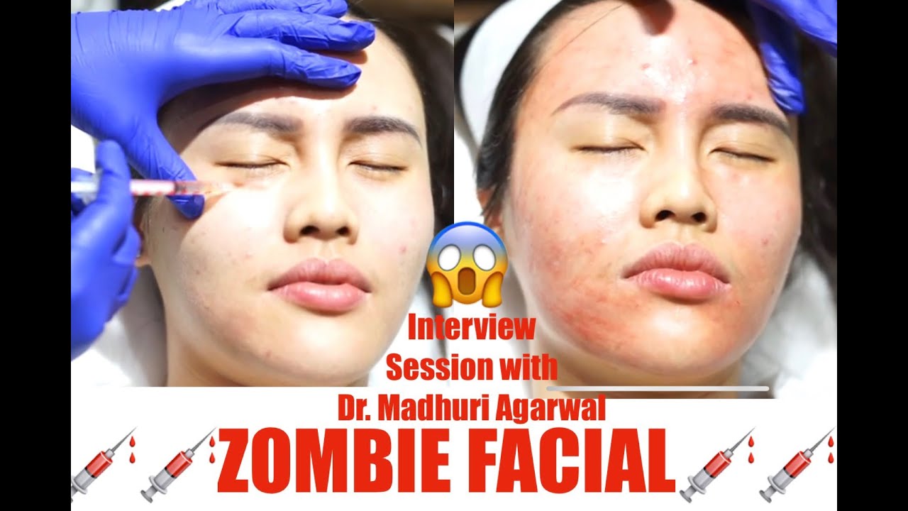 PRP Process by dr. Madhuri Agarwal | ZOMBIE FACIAL, is it scary and ...