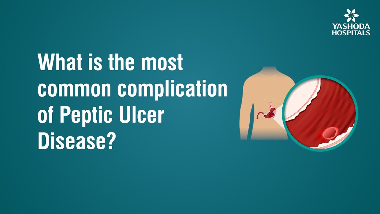 What is the most common complication of Peptic Ulcer Disease? - YouTube