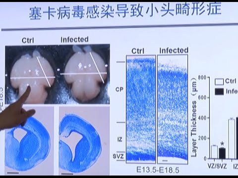 Chinese Researchers Find Direct Evidence of Zika Causing Microcephaly ...