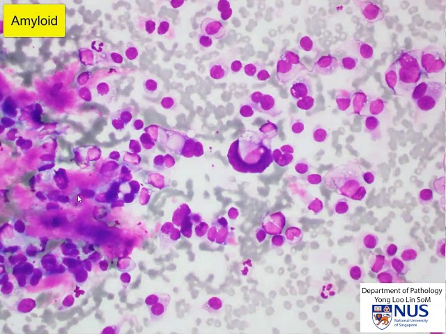 Medullary Carcinoma Amyloid