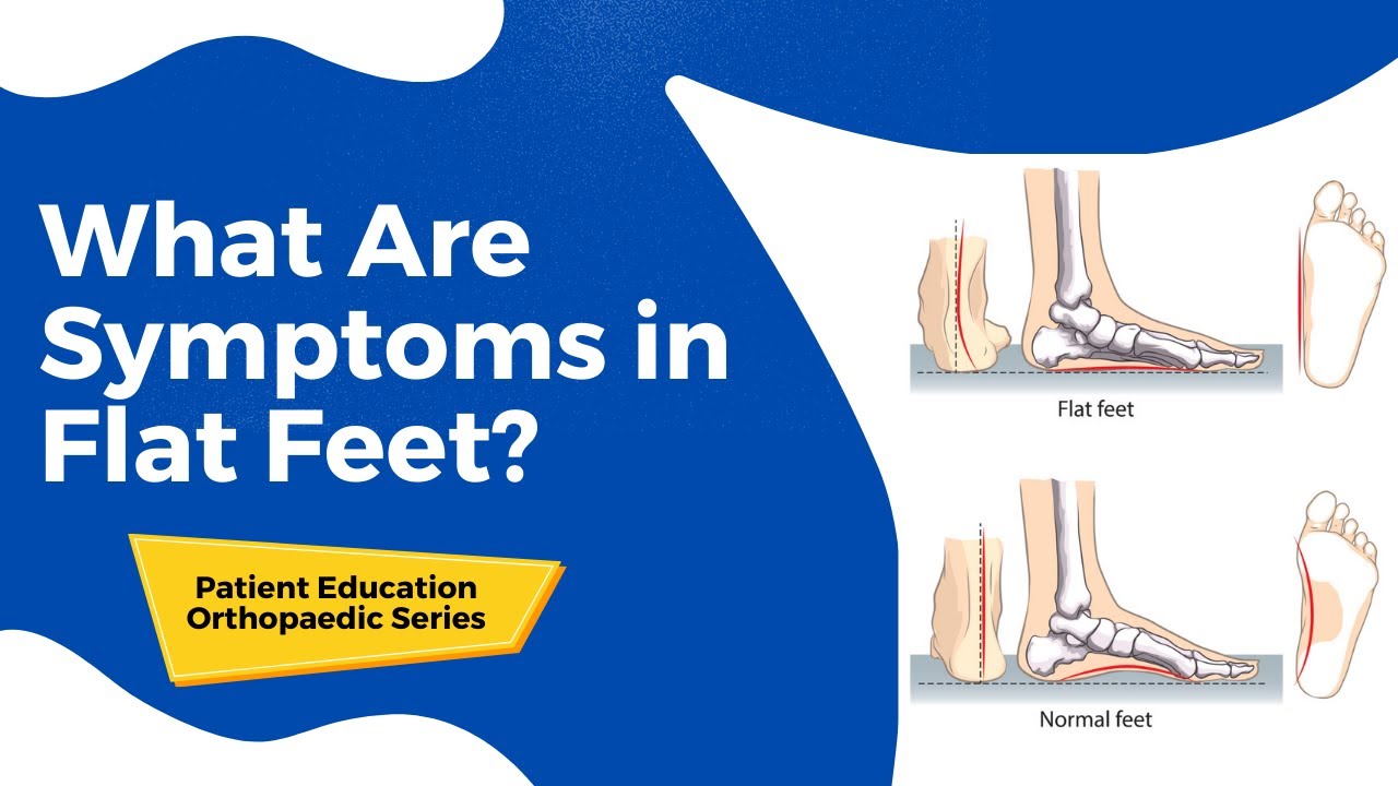 Understanding Flat Foot: Symptoms & Signs Explained by Dr. Sudhir ...