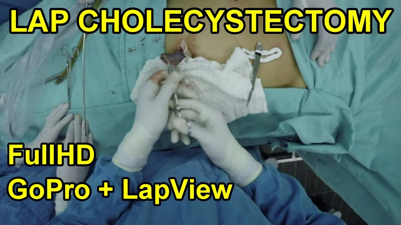 Lap Cholecystectomy - Full Surgery + GoPro + FullHD - June 2016 - YouTube