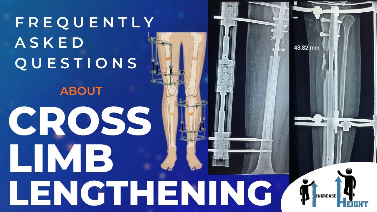 Frequently Asked Questions about Cross Limb Lengthening #FAQ , #Height ...