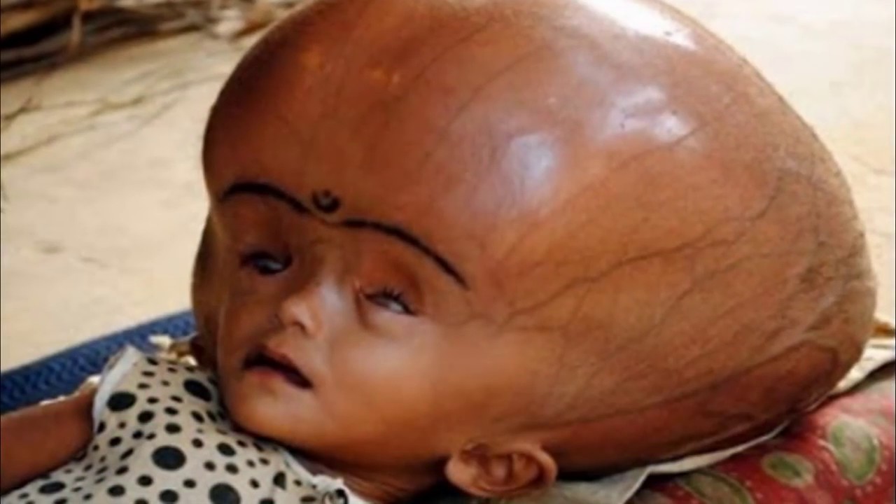 Swollen Head Baby - YouTube