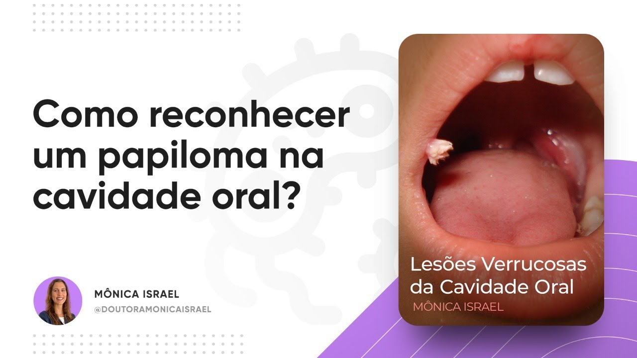 Papiloma escamoso - YouTube