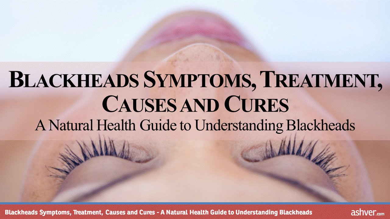 Blackheads Symptoms, Treatment, Causes and Cures - A Natural Health ...