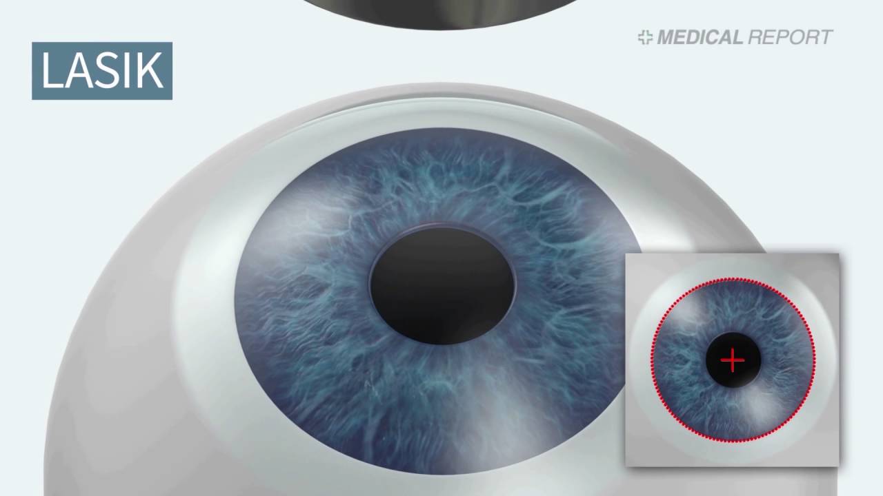 MEDICAL REPORT, lasik & lasek is really safe? - YouTube
