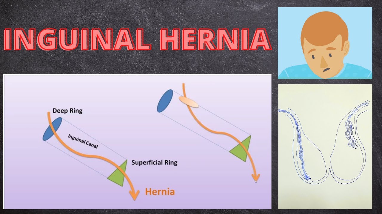 Inguinal Hernia !!! How to take History !!! How to Examine - YouTube