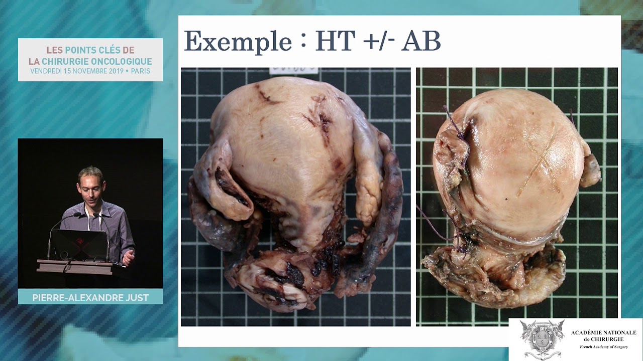 Ce que l'anatomopathologiste attend du chirurgien - YouTube