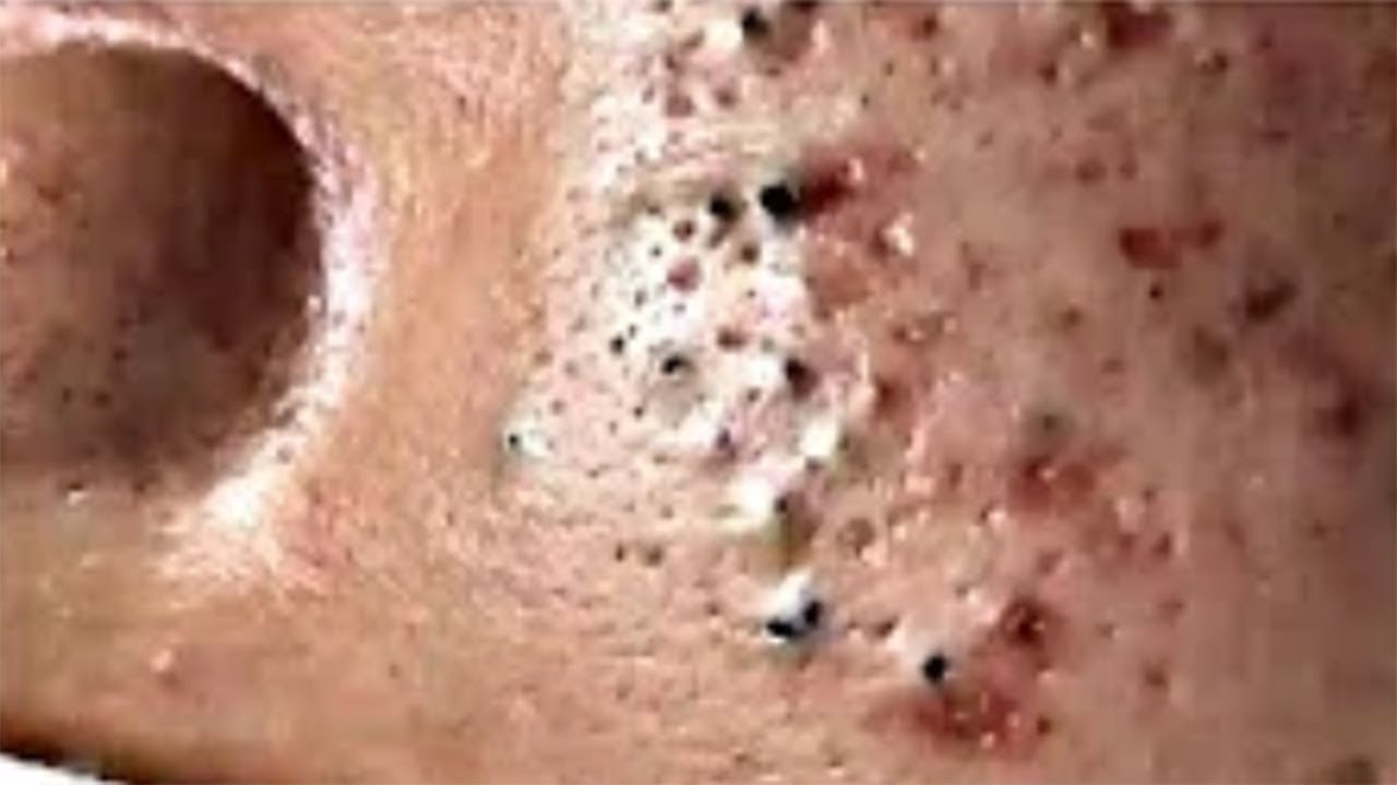 Milia,[𝑨cne Clear Th] How to Removal Blackheads & Whiteheads on Face at ...