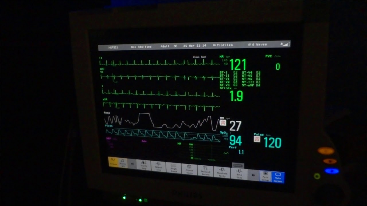 Philips IntelliVue MP70 Oxygen Desaturation Alarm - YouTube