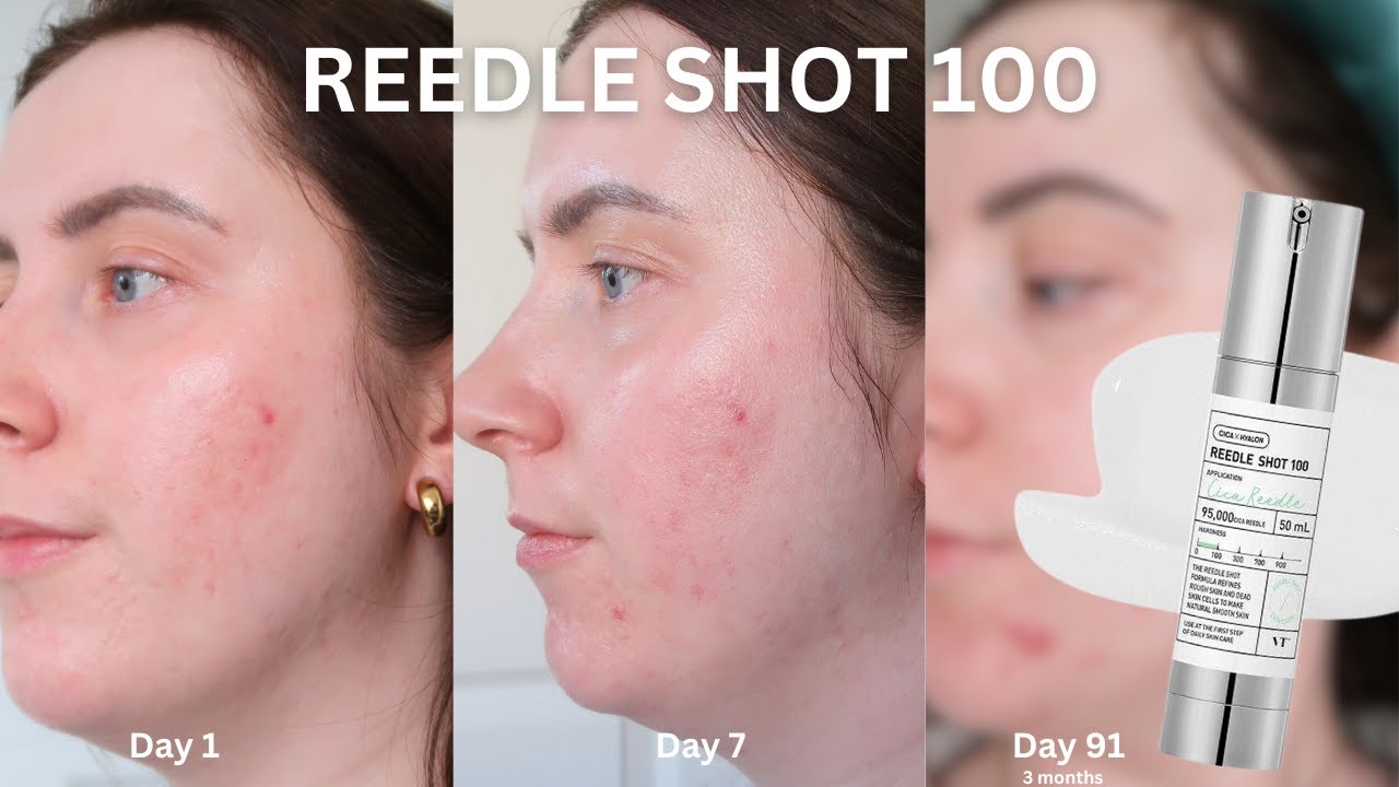 30 Days Of...VT Cosmetics Reedle Shot 100 | 3 MONTH UPDATE - YouTube
