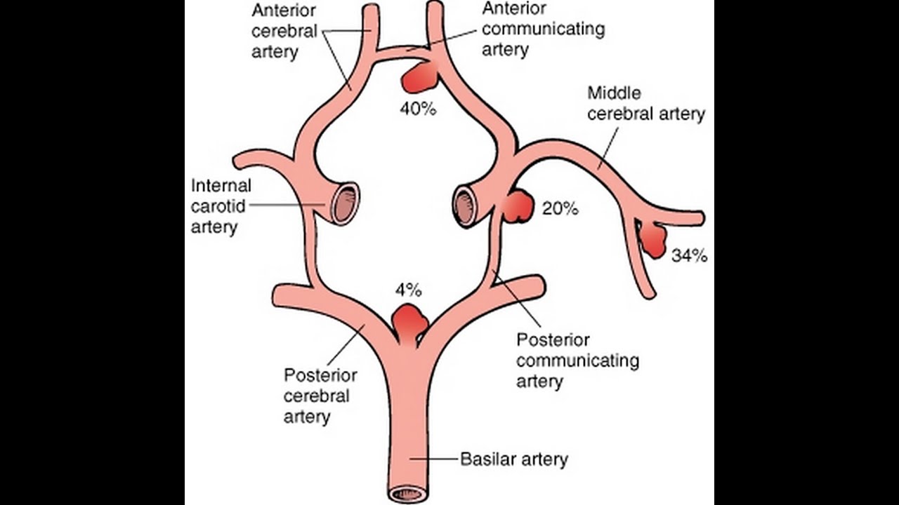 CLIPPING OF DUAL ANEURYSM - RUPTURED PCOM AND GIANT ACOM ANEURYSM - YouTube