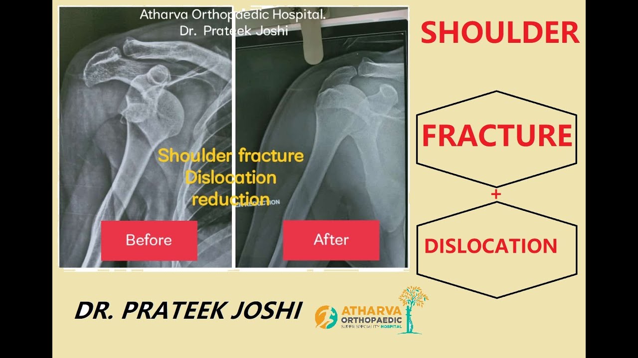 SHOULDER FRACTURE WITH DISLOCATION REDUCTION PROCEDURE - DR. PRATEEK ...