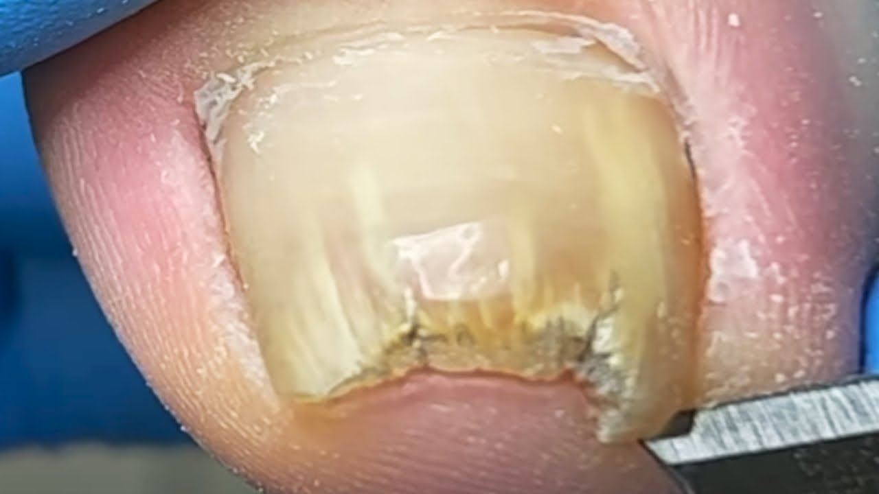 Wow~ Toenails Are Very Hard, Trimmed Hard【Xue Yidao Pedicure】 - YouTube