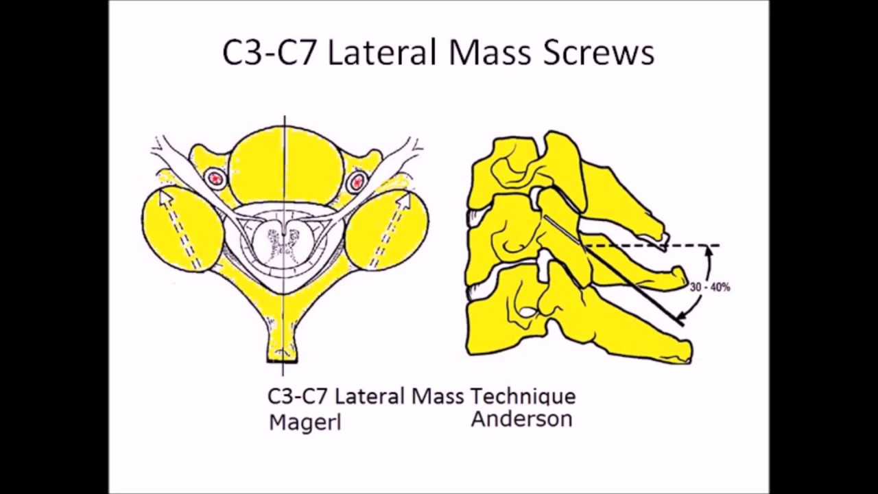 Lateral Mass Screws Movie & Lecture by Prof. Mohamed Mohi Eldin - YouTube