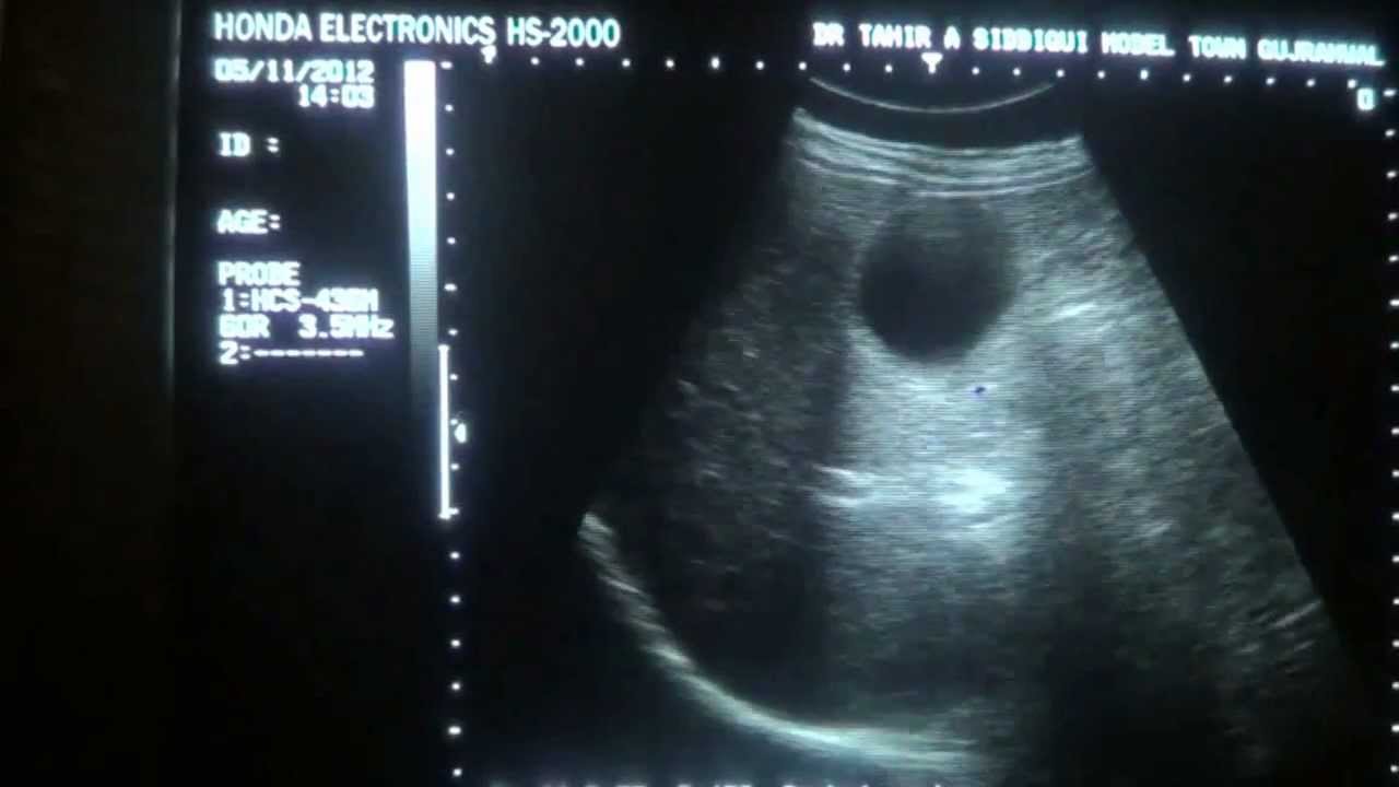 GALL BLADDER NECK CALCULUS with thick SLUDGE - YouTube