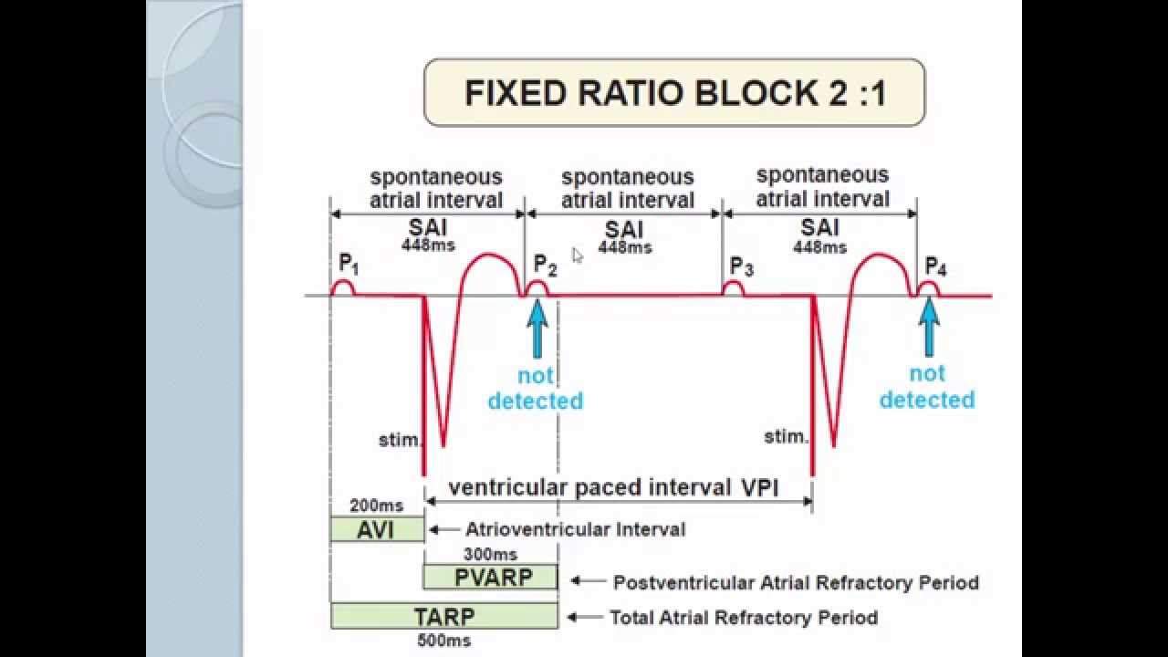 Advanced pacemaker features - YouTube