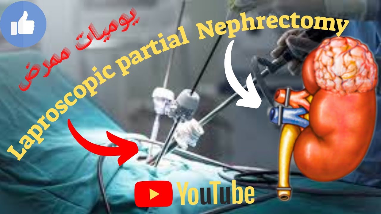 "يوميات ممرض" - الحلقة الثانيه - Laparoscopic RT simple Nephrectomy - YouTube