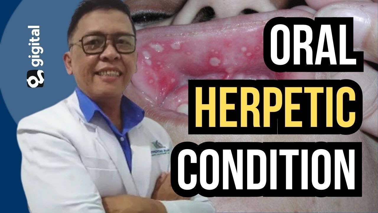 Differentiating Oral Herpetic Condition - Stomatitis herpetiformis atau ...