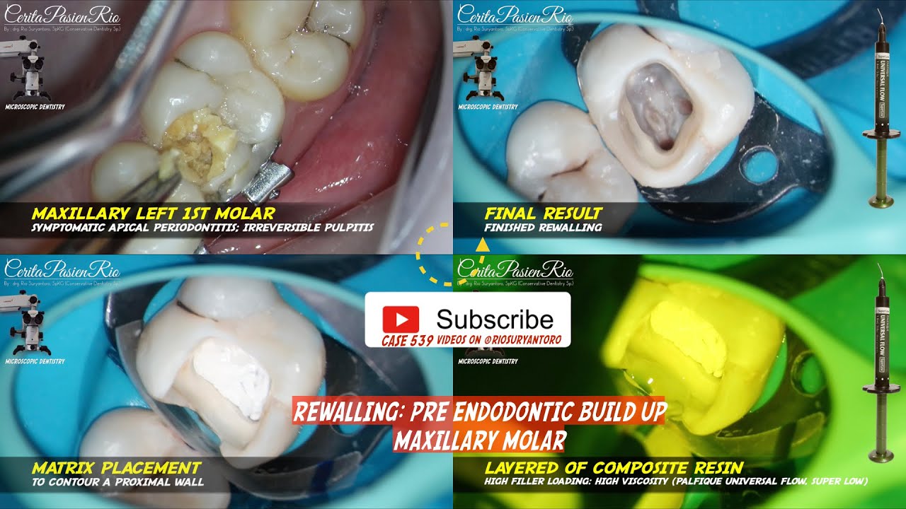 REWALLING / PRE ENDODONTIC BUILD UP MOLAR TO PREVENT GINGIVITIS ...