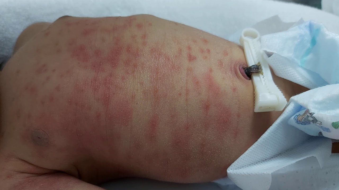 case 444 photo sensitivity ( phototherapy) vs Erythema toxicum ...