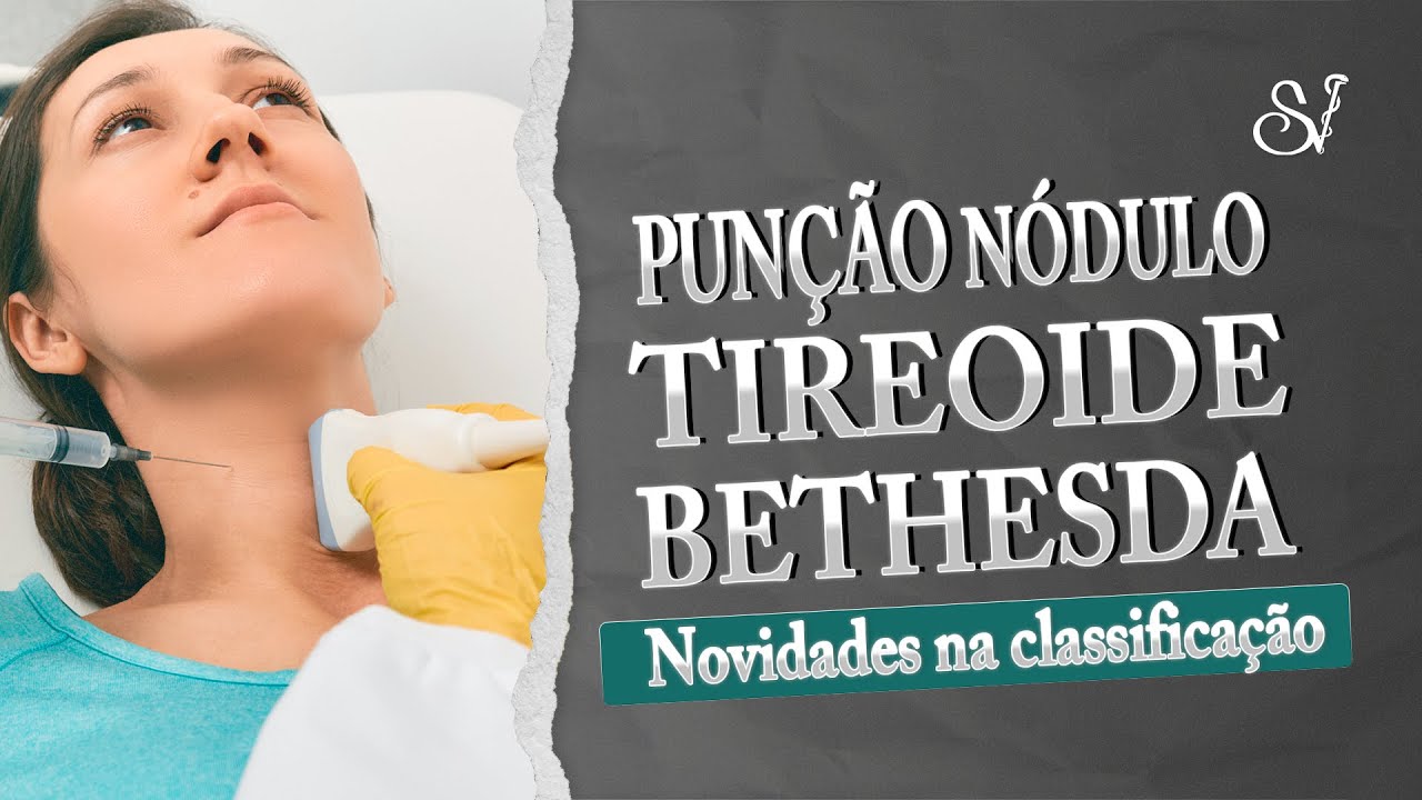 Sistema Bethesda 2023 - novidades para punção de nódulos de tireoide ...
