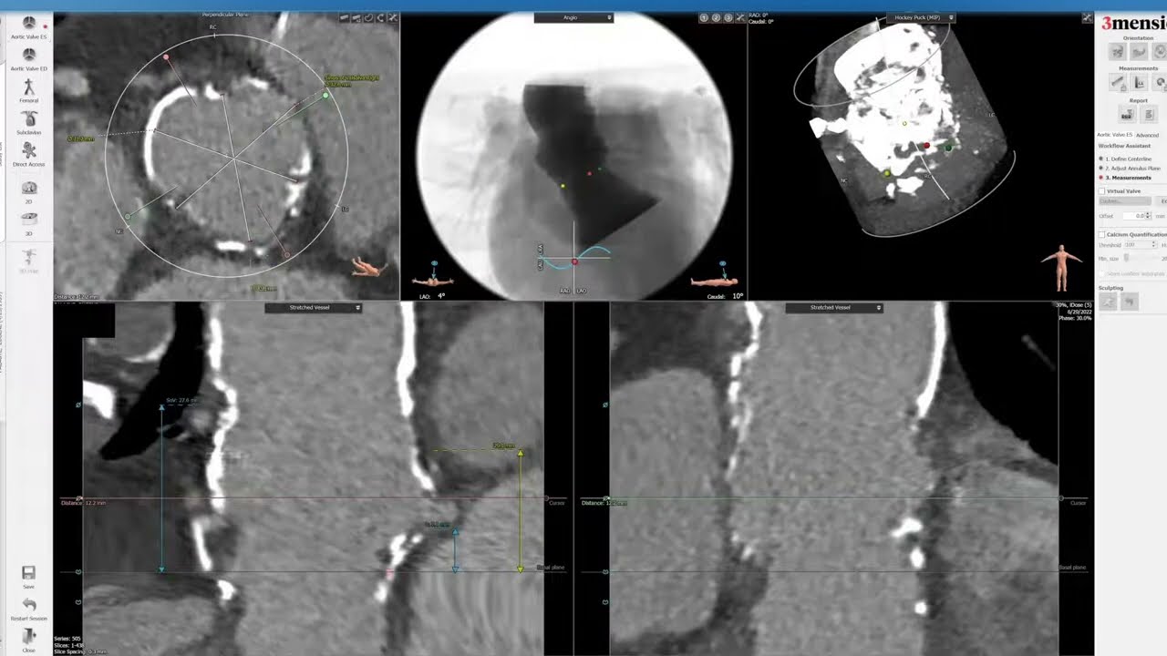 3Mensio CT Pre-case Planning: Valve-in-Valve TAVR in Homograft - YouTube