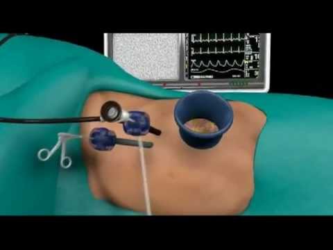 Böbrek Naklinde Retroperitonoskopik Nefrektomi