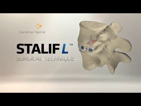STALIF L Surgical Technique - YouTube
