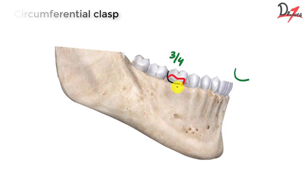 Removable appliances | Retentive components| Clasps - YouTube
