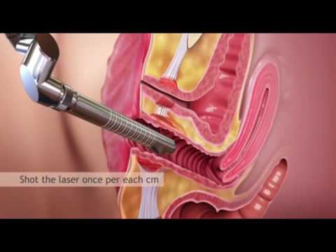 Lazerle Vajina Daraltma (Vajinal Rejuvenasyon) Ameliyatı.