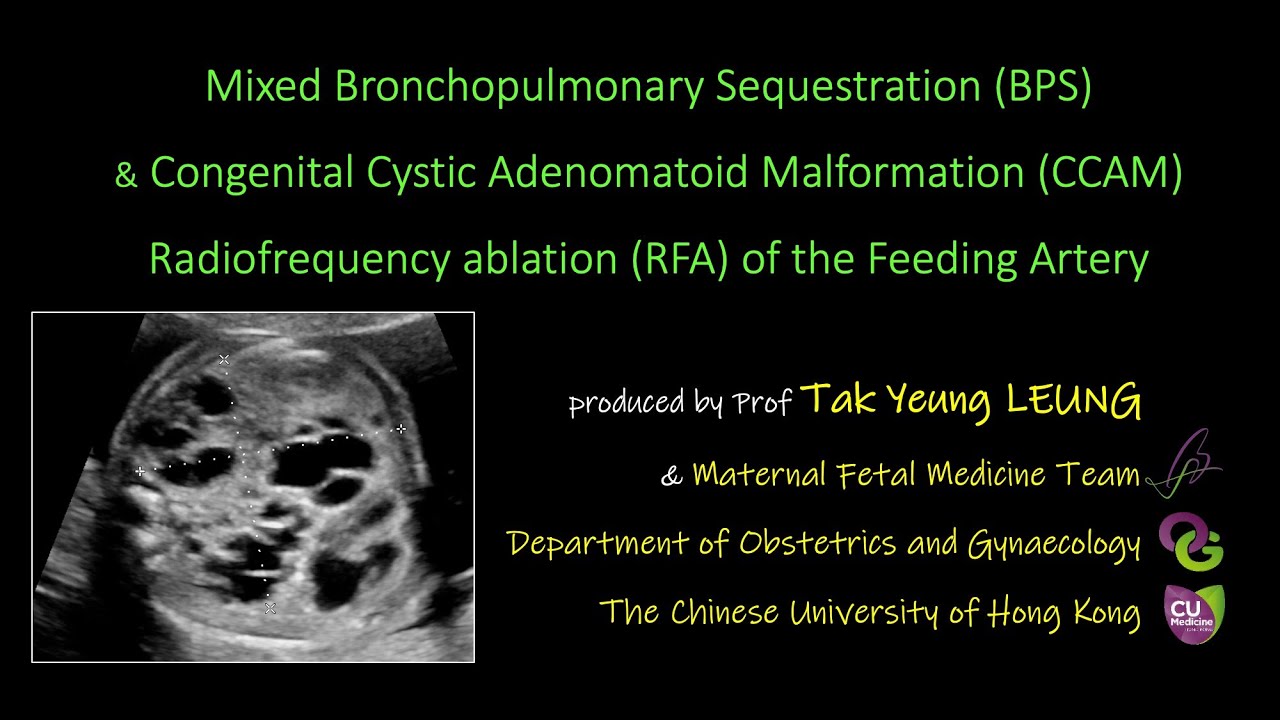 Mixed Bronchopulmonary Sequestration Congenital Cystic Adenomatoid mixed-bronchopulmonary-sequestration-congenital-cystic-adenomatoid
