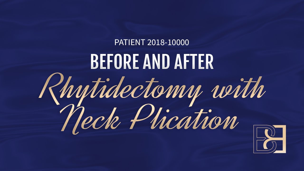 Rhytidectomy (Full Facelift) {Patient 2018-10000} Before & After - YouTube