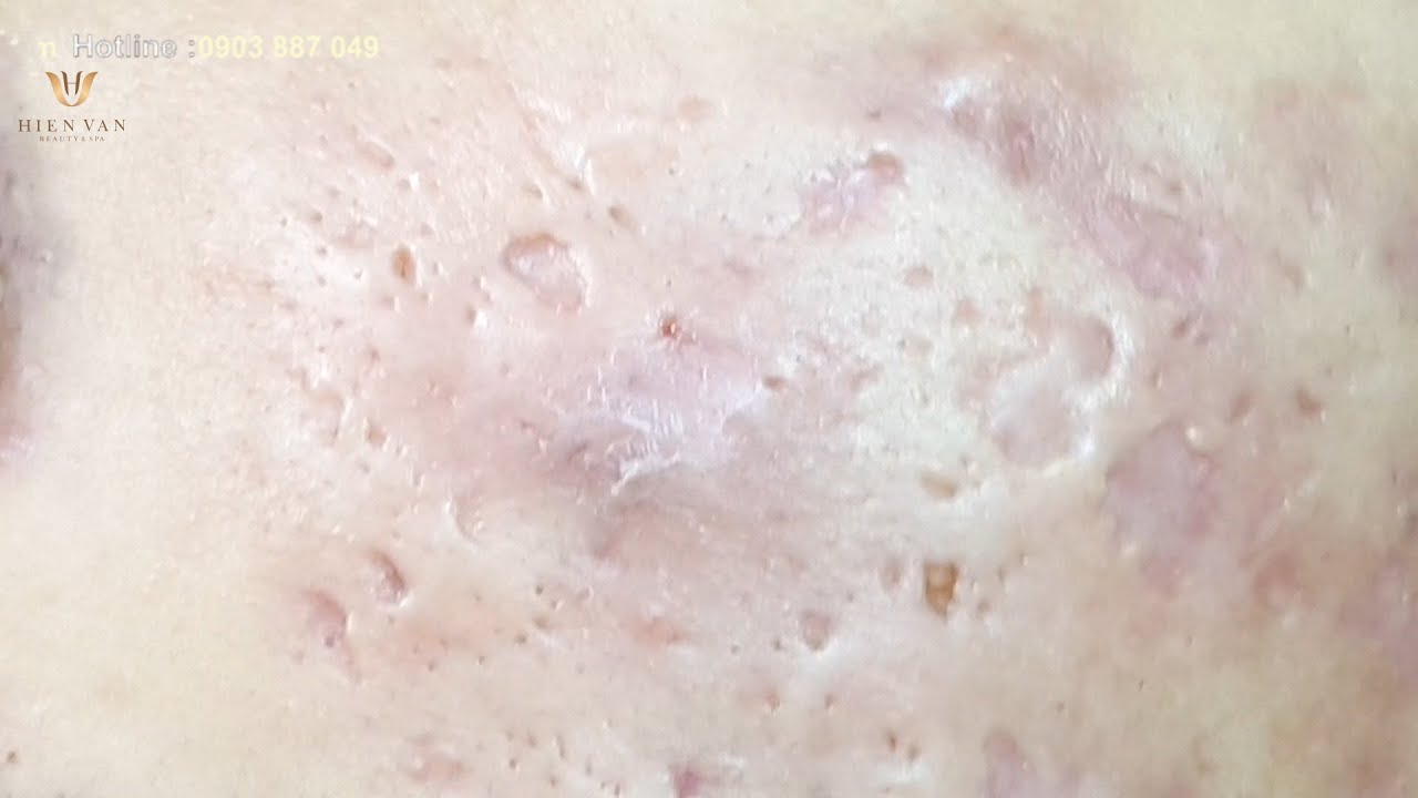 Extraction "acne" at hien van spa|360| Cao Xuân Thắng - YouTube