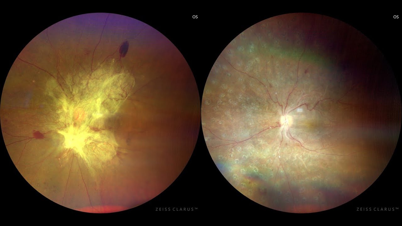 PDR - Extensive Fibro-Vascular Proliferation - Power of the Cutter ...