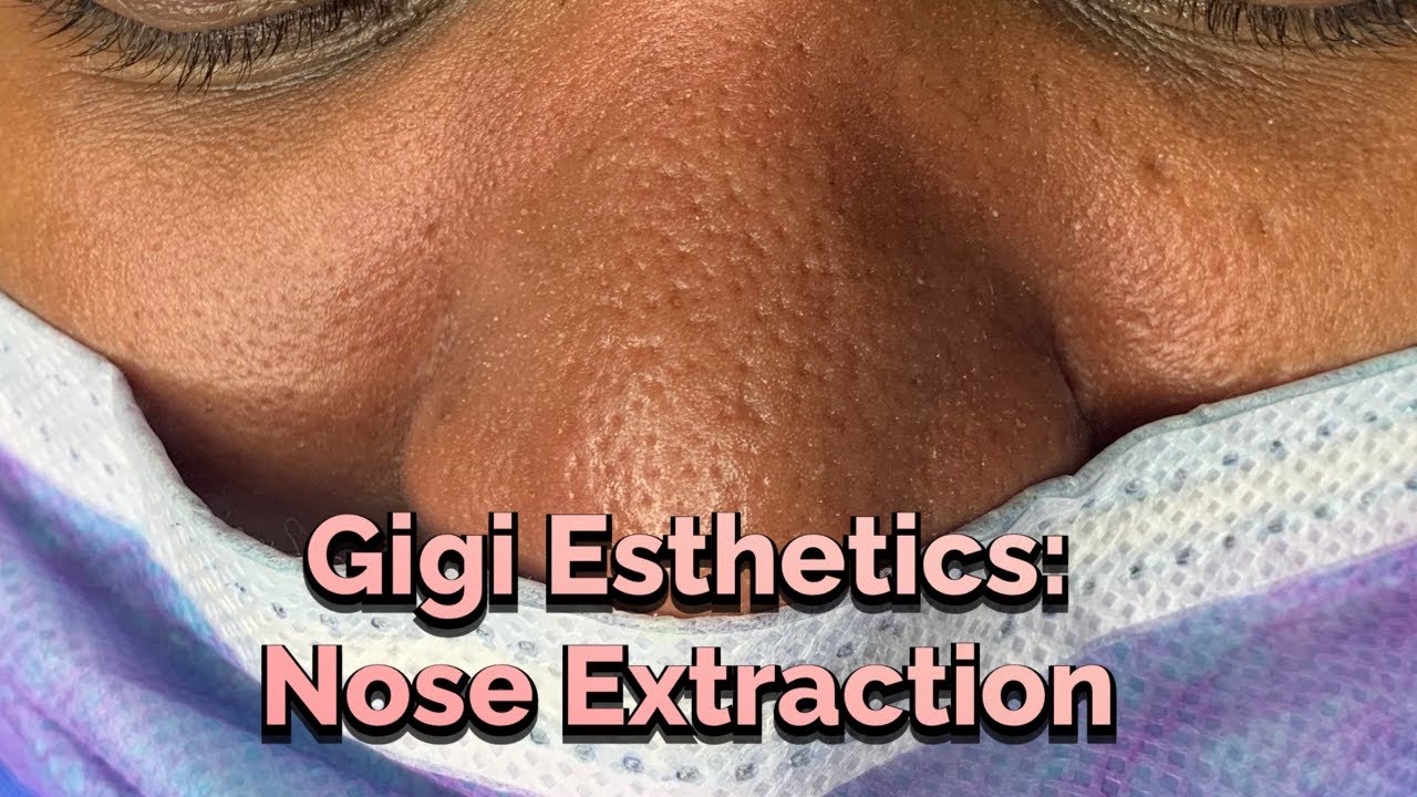 Gigi Esthetics: Nose Extraction - YouTube
