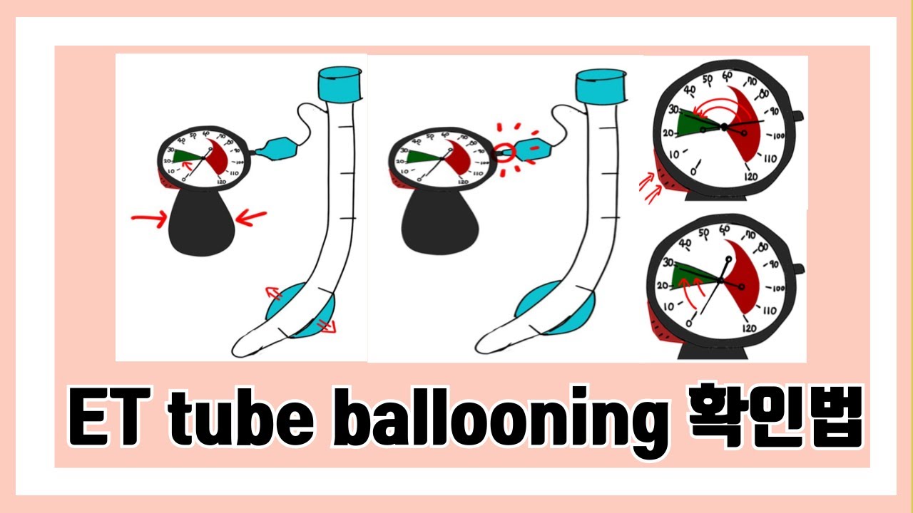 Endo tracheal tube 간호 ballooning 확인법 #간호 #간호조무사 #간호학과 #간호학생 #간호대생 #간호사 ...