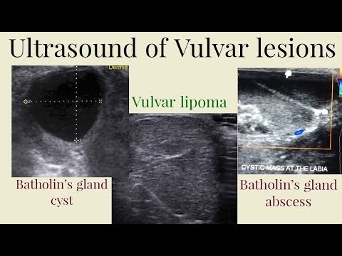 Ultrasound of Vulvar lesions. Batholin's gland cyst. vulvar lipoma ...